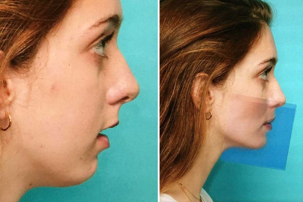 Jaw Surgery: All the Essentials You Need to Know - Body Health Advisor ...